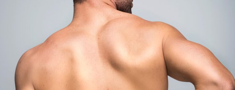 Risques & stimulation lors de l’épilation laser du dos | Dr Husson ...